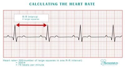 Reading ECG: Made Simple for Nurses - Nurseslab