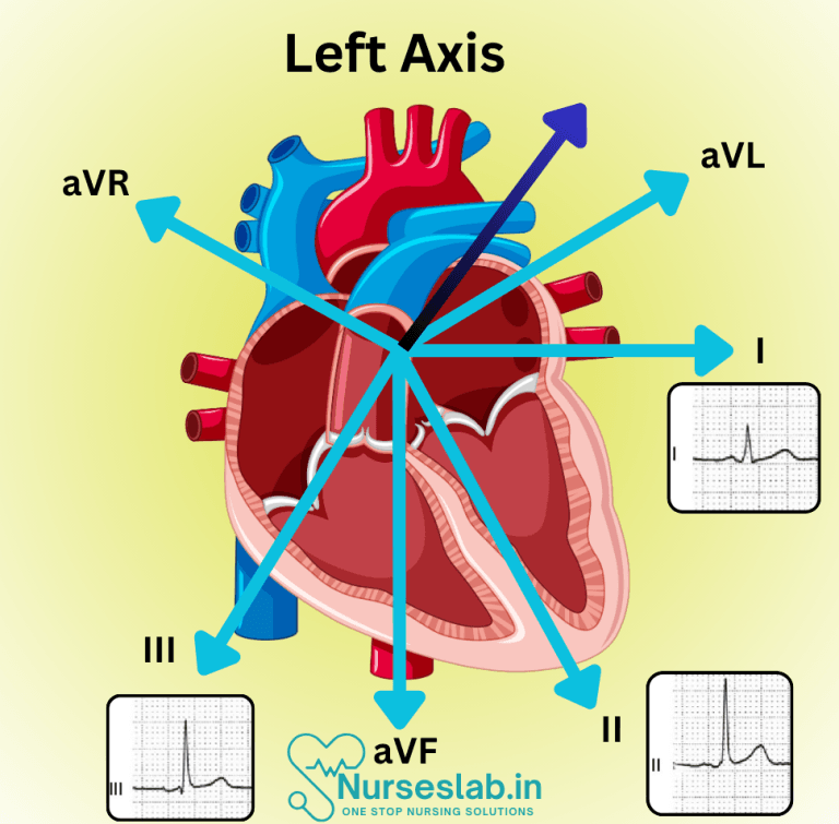 Reading ECG: Made Simple for Nurses - Nurseslab