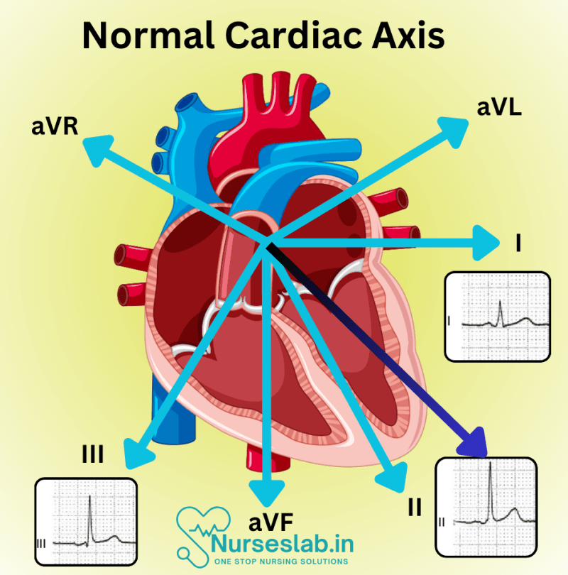 Reading ECG: Made Simple for Nurses - Nurseslab.in