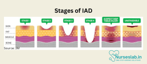 What is Incontinence Associated Dermatitis(IAD)? How to Manage it ...