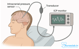 Intracranial Pressure (ICP) Monitoring - Nurseslab