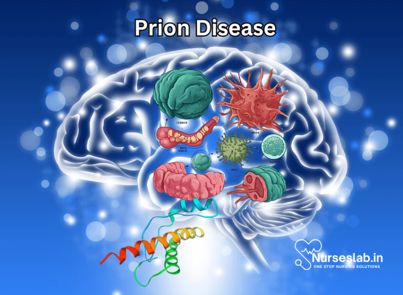 Prion Disease: An Overview of a Unique Neurodegenerative Disorder ...