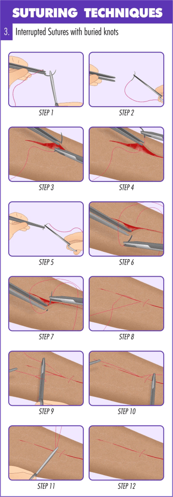 How to do Suturing: Explained - Nurseslab