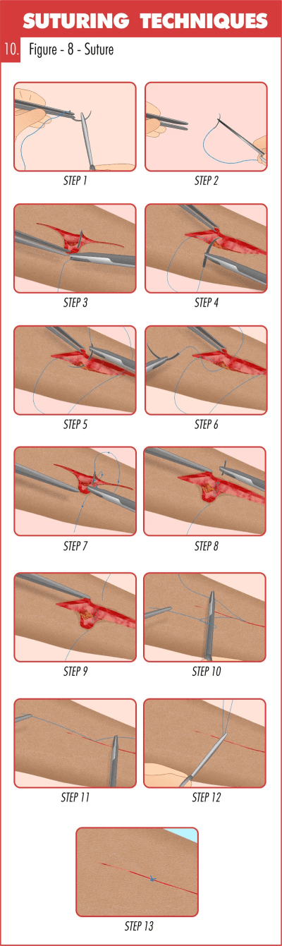 How to do Suturing: Explained - Nurseslab