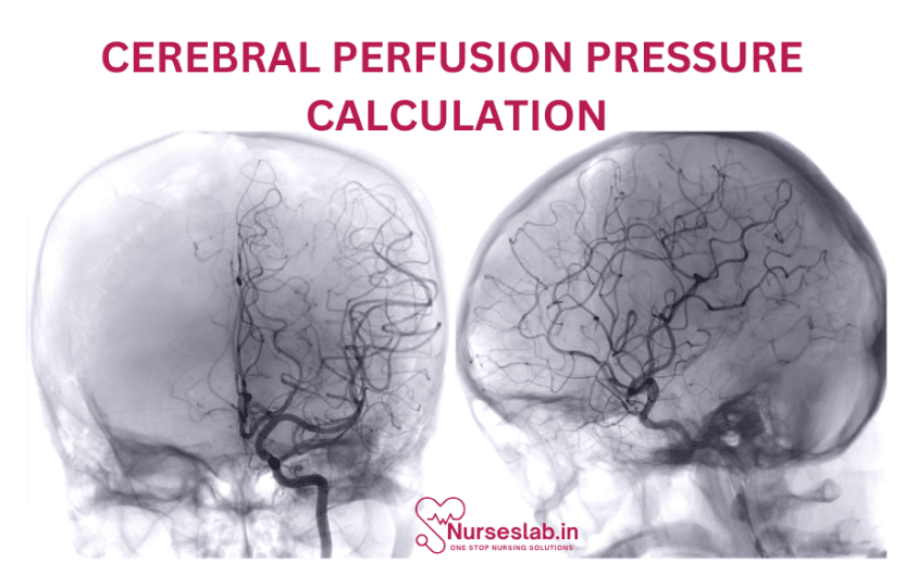 Calculating Cerebral Perfusion Pressure: Explained - Nurseslab.in