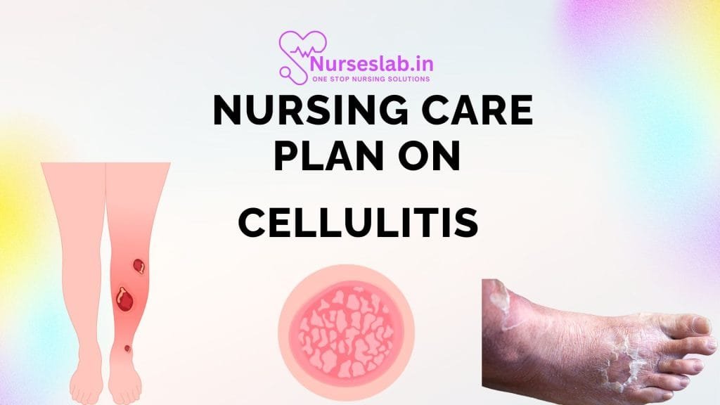 Nursing Care Plan on Cellulitis - Nurseslab