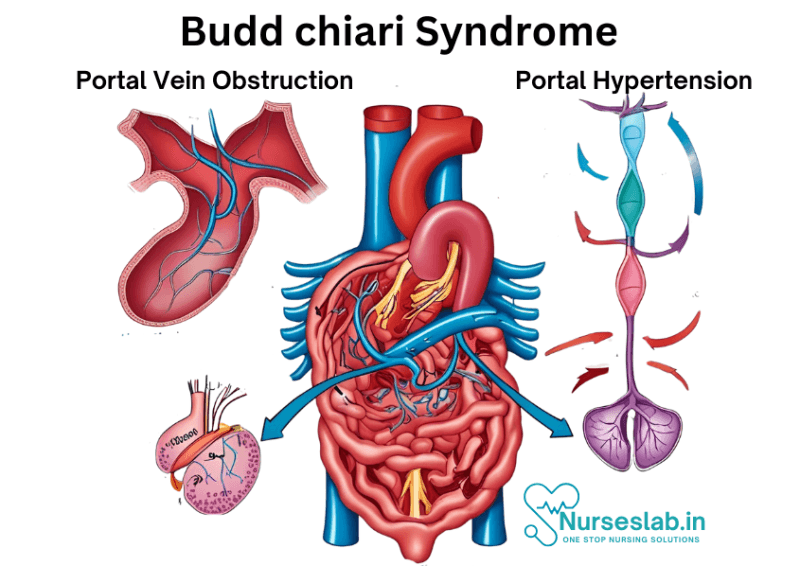 Budd-Chiari Syndrome (BCS) - Nurseslab