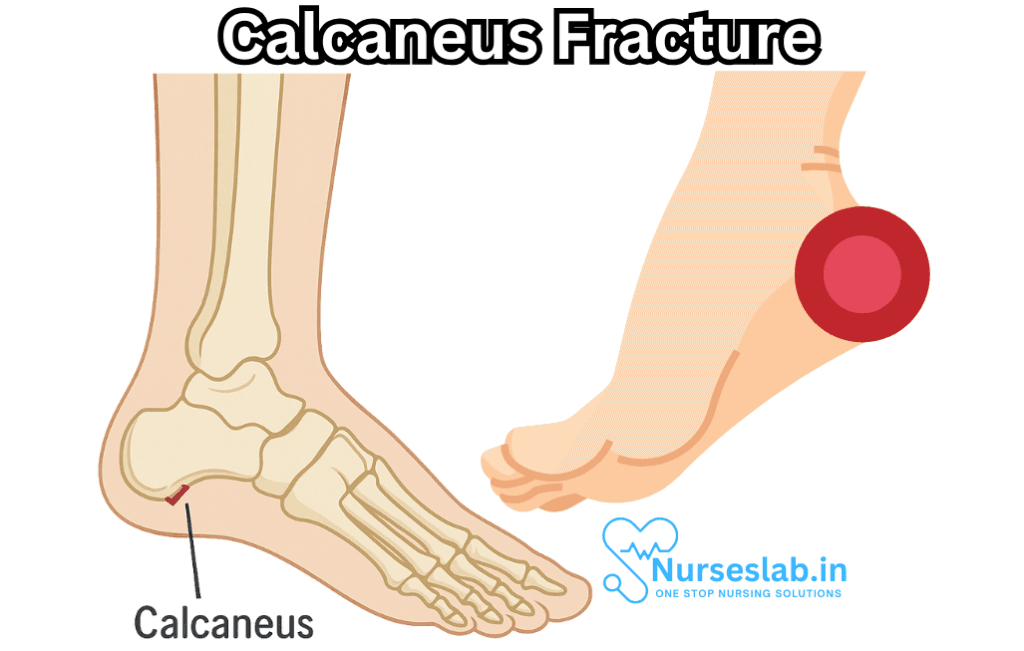 Calcaneus Fracture (Broken Heel) - Nurseslab