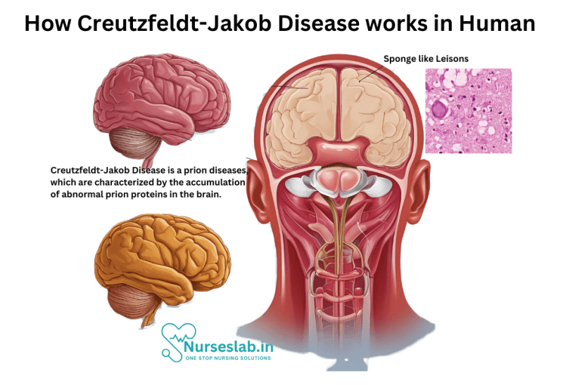 Creutzfeldt-Jakob Disease (CJD): An Overview and Insight into a Rare ...