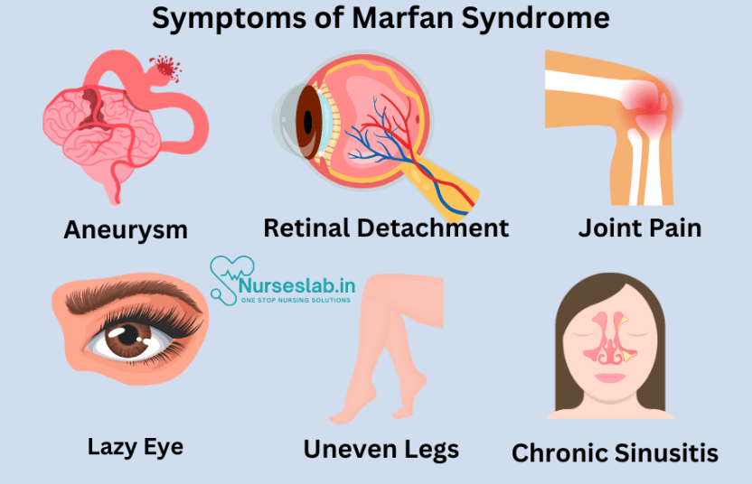 Marfan Syndrome: A Comprehensive Overview - Nurseslab