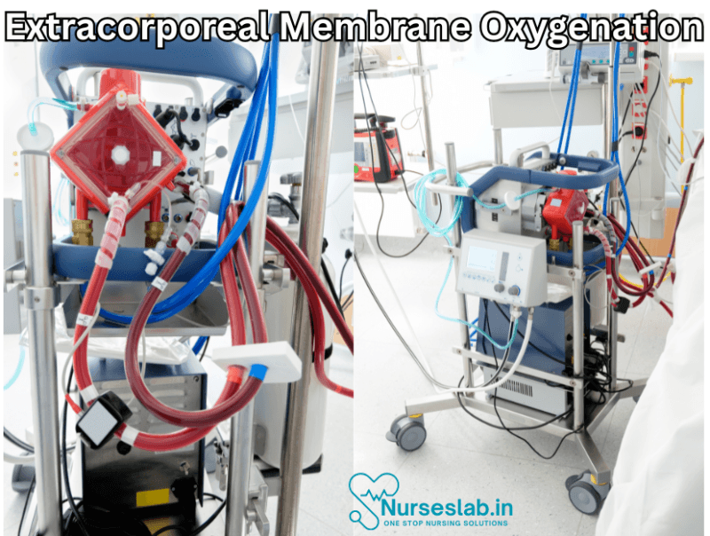 Basics of Extracorporeal Membrane Oxygenation (ECMO) - Nurseslab