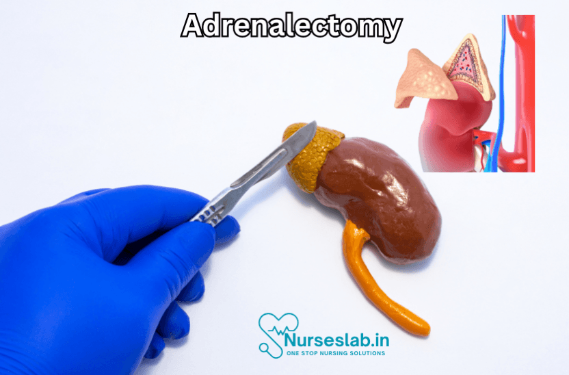 Adrenalectomy (Adrenal Gland Removal Surgery) - Nurseslab