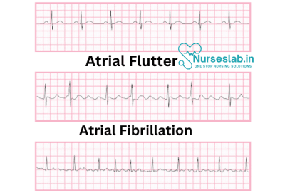 Atrial Arrhythmia: Is it Fibrillation or Flutter? - Nurseslab
