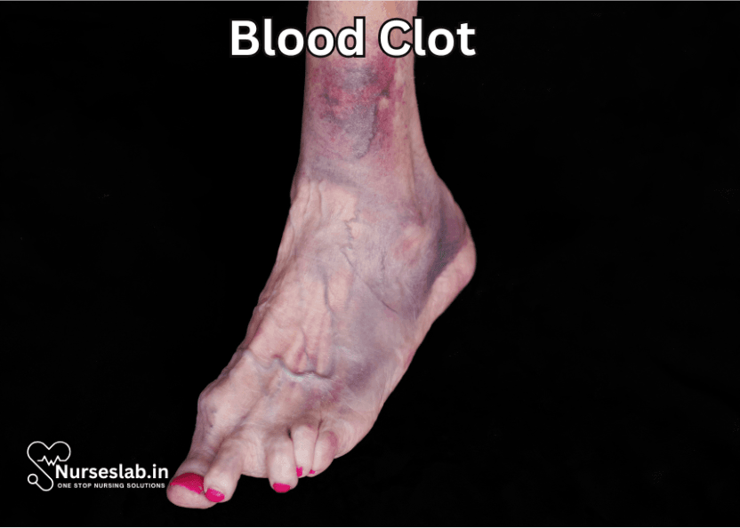 First Aid for Blood clots - Nurseslab