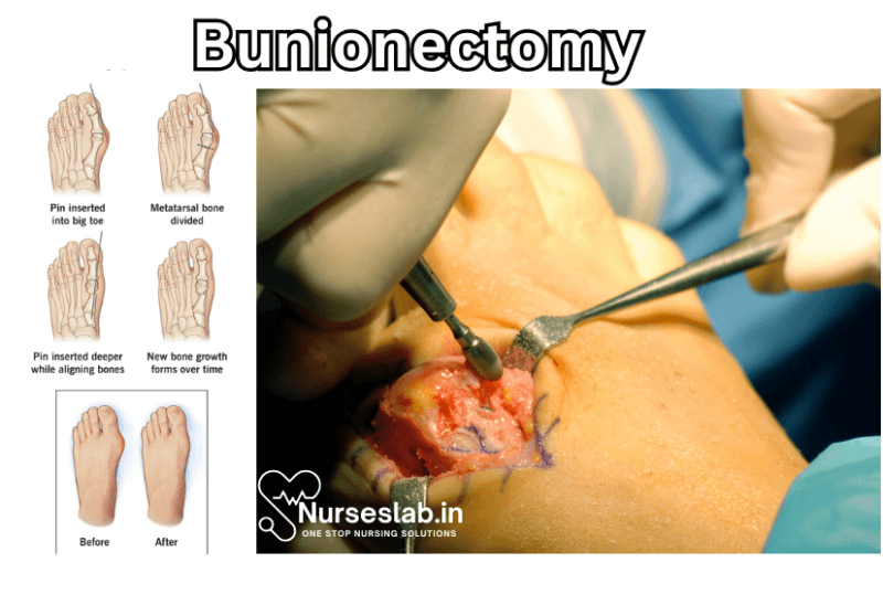 Bunion Surgery (Bunionectomy)- Overview - Nurseslab