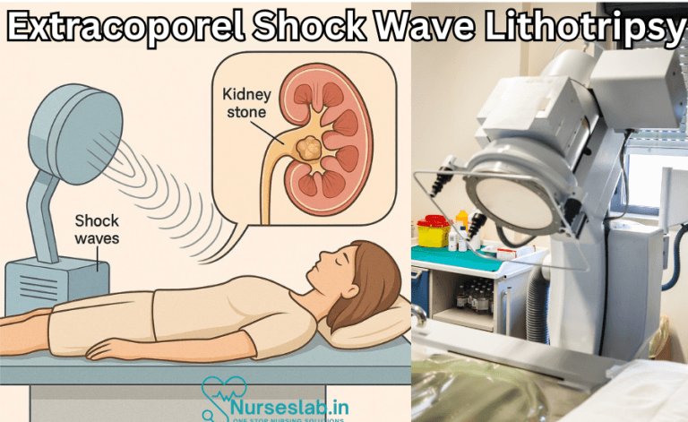 Extracorporeal Shock Wave Lithotripsy (ESWL) - Nurseslab