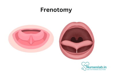 Frenotomy (Tongue-Tie Surgery in Infants) - Nurseslab