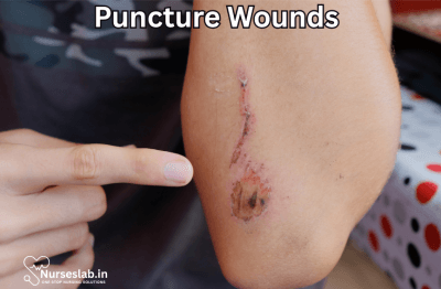 First Aid for Puncture Wounds - Nurseslab
