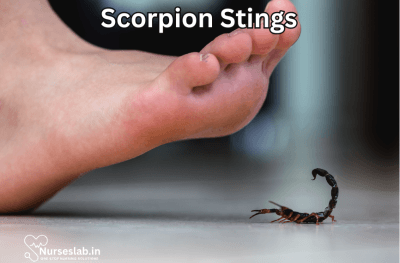First Aid for Scorpion Stings - Nurseslab