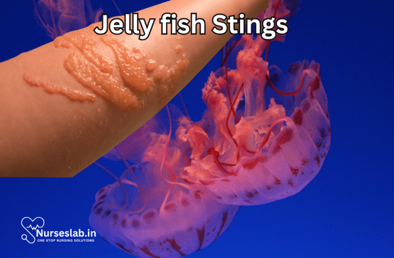 First Aid for Jellyfish Stings - Nurseslab