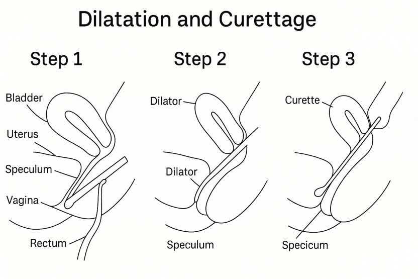 Dilation and Curettage (D & C) - Nurseslab