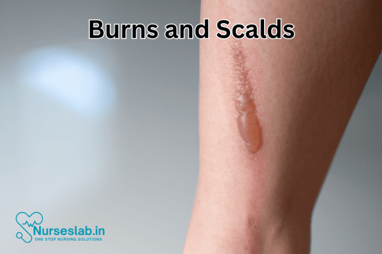 First Aid for Burns and Scalds - Nurseslab