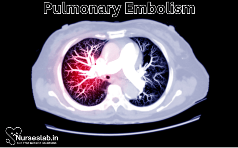 First aid for Pulmonary Embolism (PE) - Nurseslab