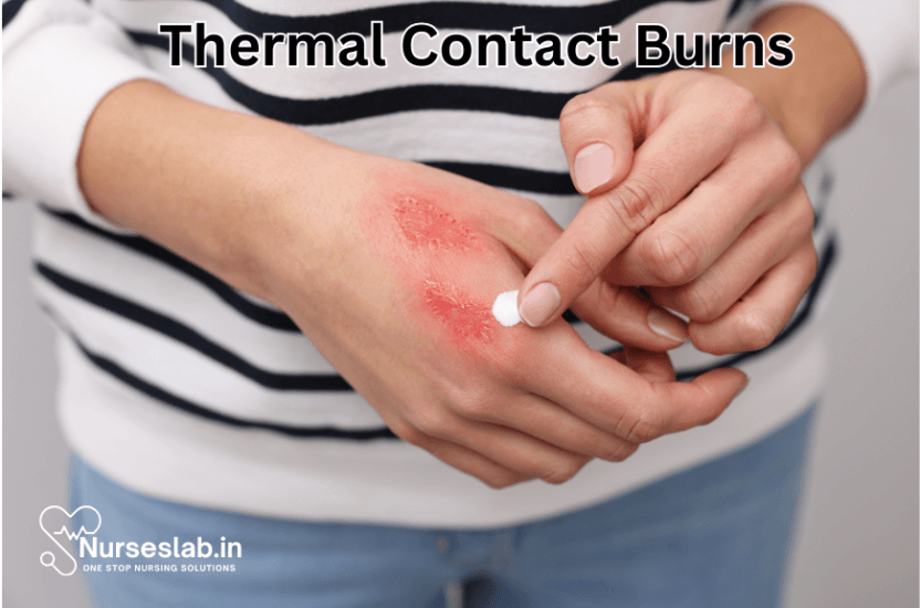 First Aid for Thermal Contact Burns - Nurseslab