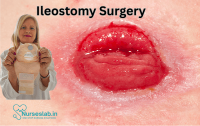 Ileostomy Surgery - Nurseslab