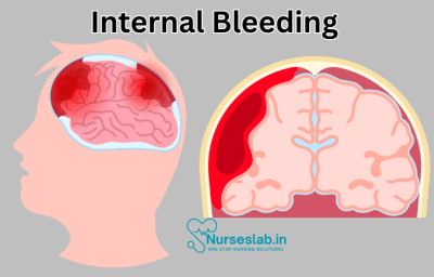 First Aid for Internal Bleeding - Nurseslab
