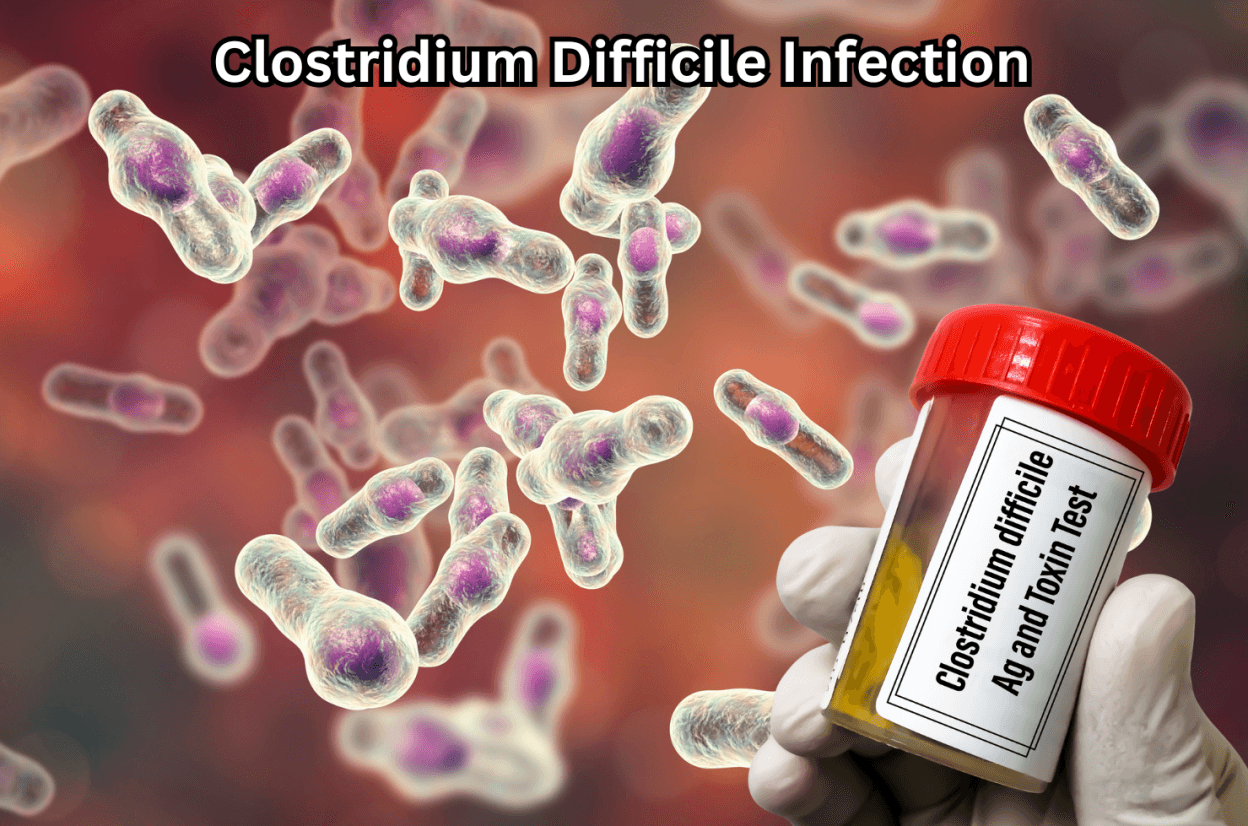 Clostridium difficile Infection - Nurseslab