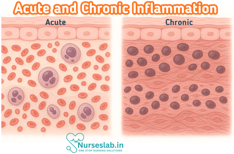 Acute and Chronic Inflammation - Nurseslab