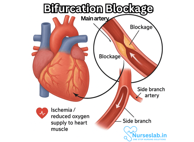 CAD: Bifurcation Blockage - Nurseslab
