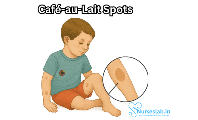 Café-au-Lait Spots - Nurseslab