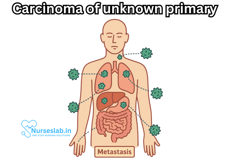 Carcinoma of Unknown Primary - Nurseslab