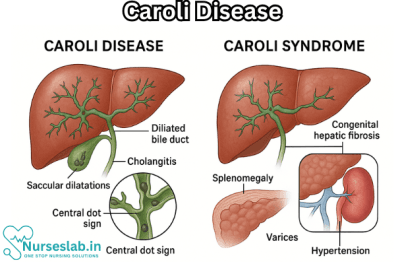 Caroli Disease – A Comprehensive Review - Nurseslab