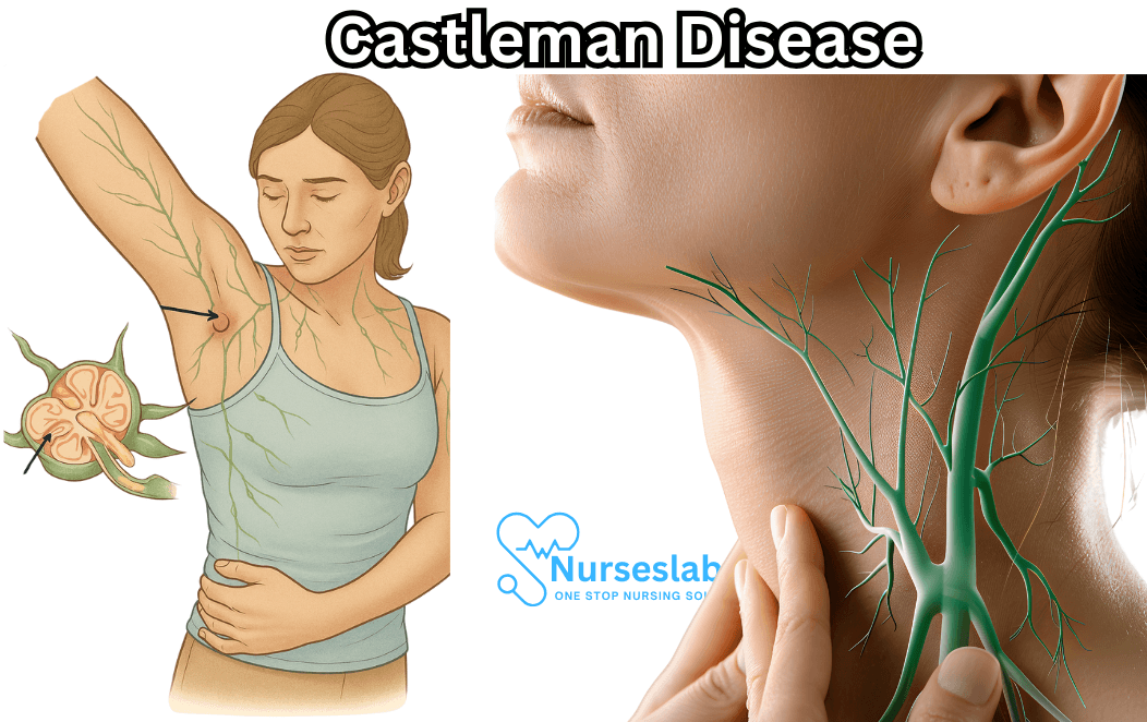 Castleman Disease - Nurseslab