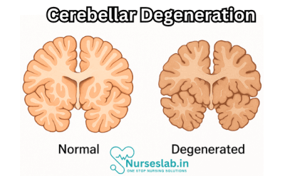 Cerebellar Degeneration Disease: An In-Depth Overview - Nurseslab