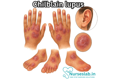 Chilblain Lupus: A Comprehensive Overview - Nurseslab