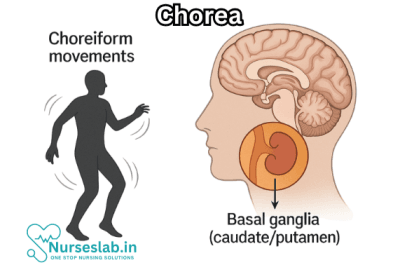 Chorea : A Comprehensive Overview - Nurseslab