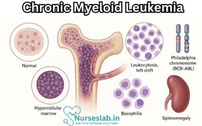 Chronic Myeloid Leukemia (CML): An In-depth Overview - Nurseslab