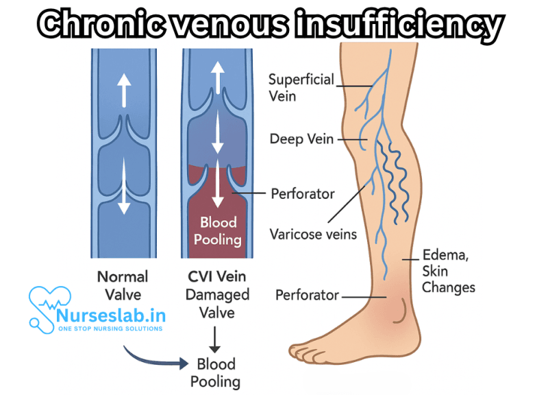 Chronic Venous Insufficiency Cvi Nurseslab