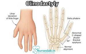 Clinodactyly: A Comprehensive Overview - Nurseslab