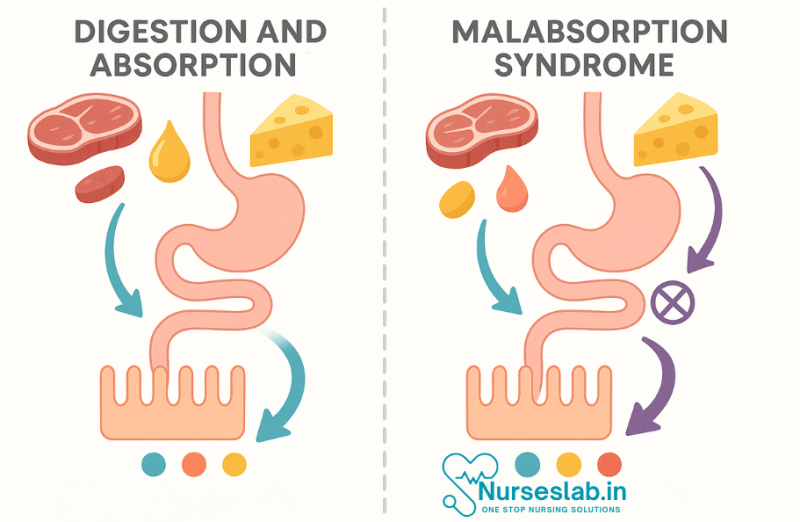 Digestion and Absorption, and Malabsorption Syndrome: Factors ...