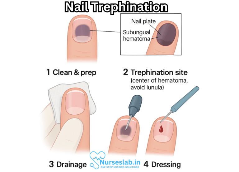 Nail Trephination - Nurseslab