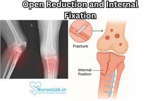 Open Reduction and Internal Fixation (ORIF) - Nurseslab