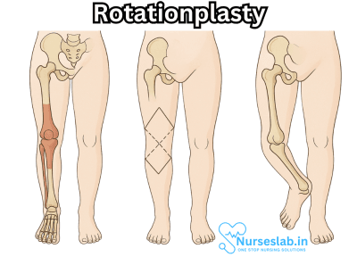 Rotationplasty - Nurseslab