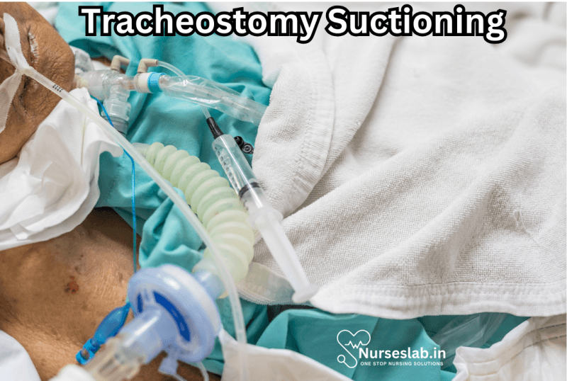 Tracheostomy Suctioning - Nurseslab